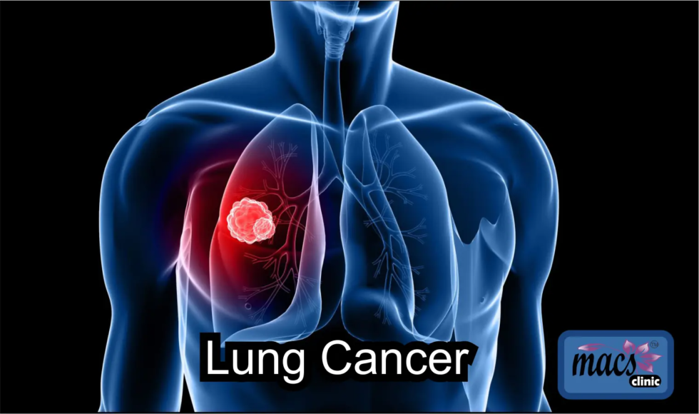 Lung Cancer Screening… How to Detect Early & Cure - MACS Clinic
